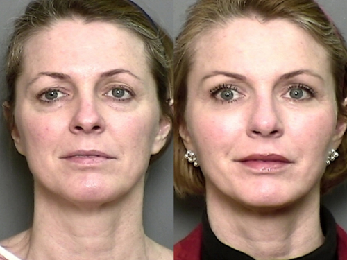 Cosmetic orbital surgery - Dr. Amin Nasr - Plastic & Eye Surgery in Lebanon