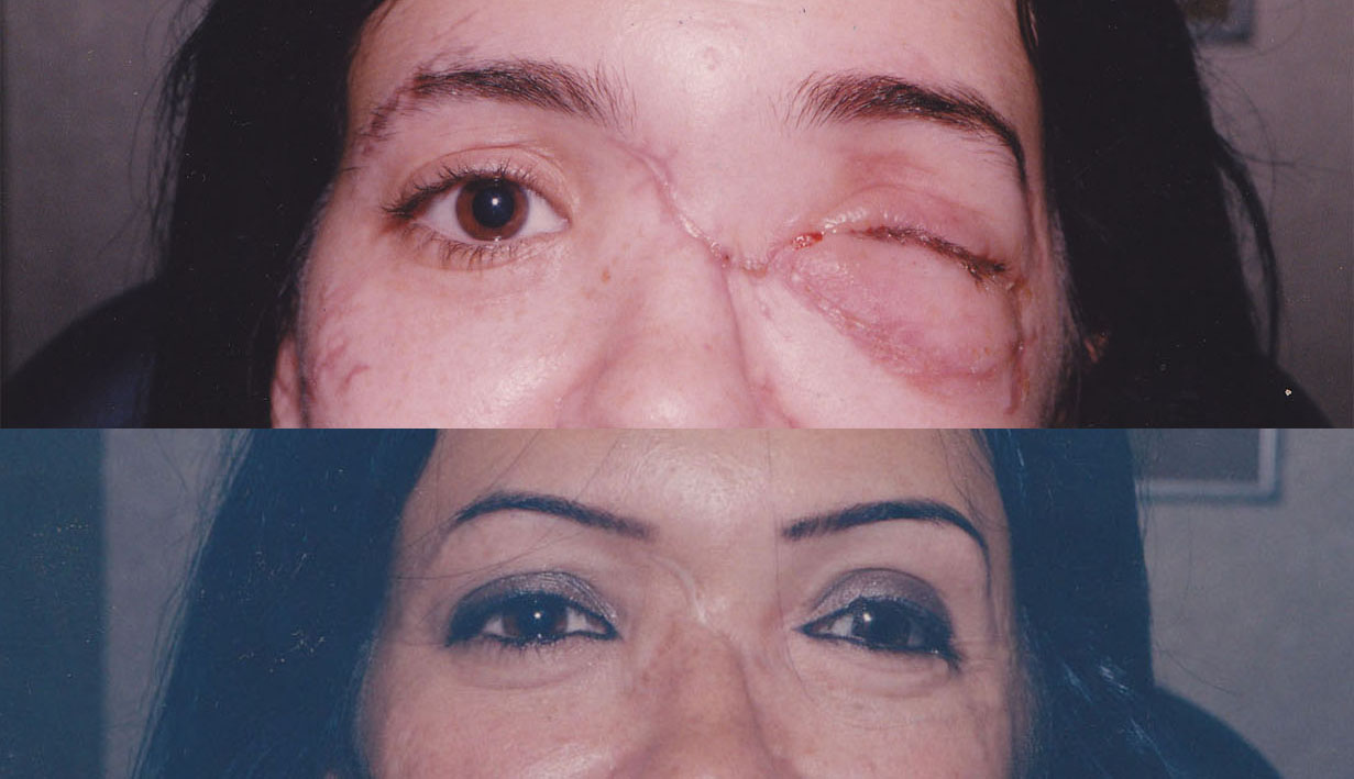 Medical orbital surgery - Dr. Amin Nasr - Plastic & Eye Surgery in Lebanon